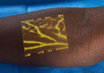 Christie Medical Holdings VeinViewer Vision2 Holding Vision 2 Field ...